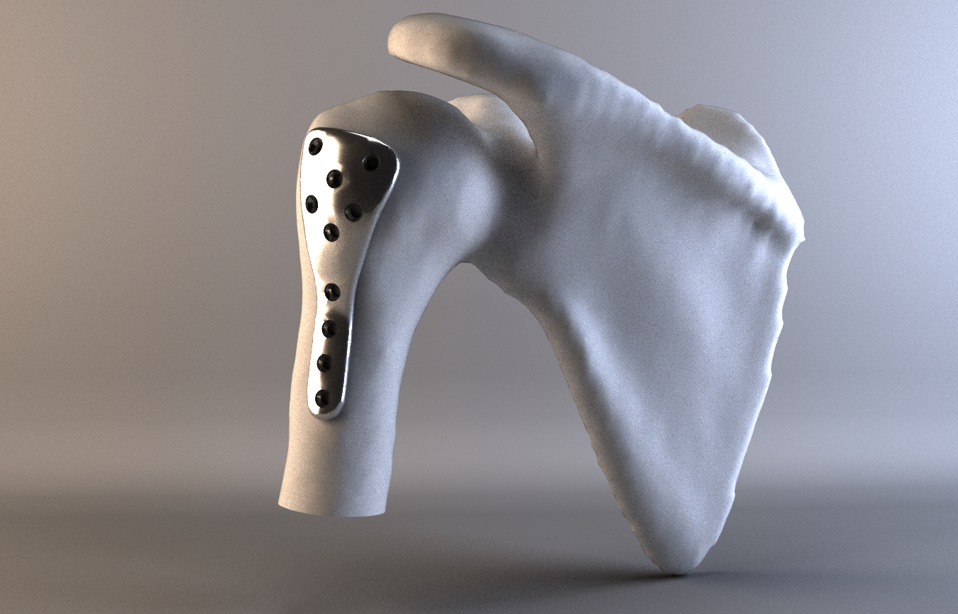 CUSTOMIZAR® — TRAUMA, MAXILOFACIAL, ORTESIS....